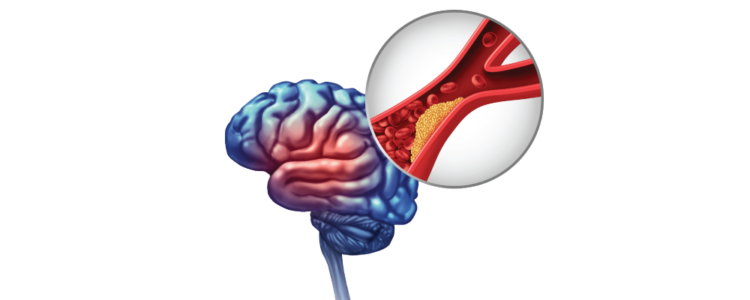 Brain Hemorrhage Surgery – jayun shah